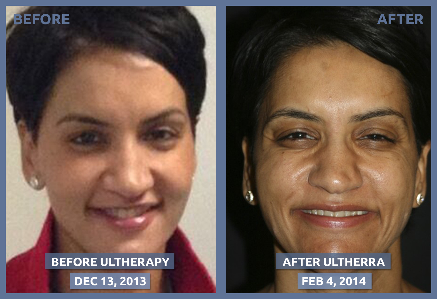 My Ultherapy Damage | Sharing My Ultherapy Experience